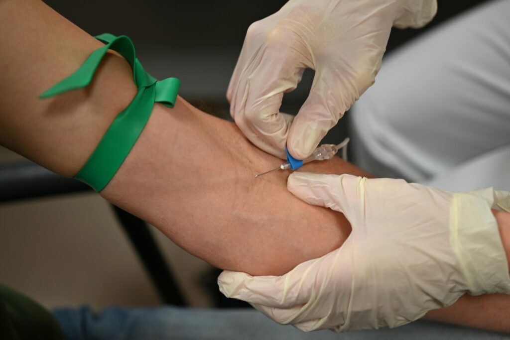 Spider Veins & Vascular Lesions - Opal Elite Clinic